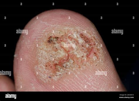 Close Up Of A Verruca Wart On The Big Toe In A 47 Year Old Male