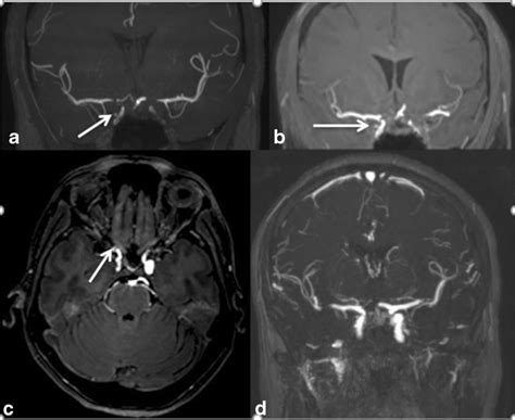 After Endovascular Treatment Of The Right Ica Supraclinoid Segment