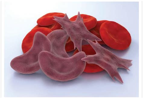 Solved Three Variants Of The Gene Encoding The Globin Component Of