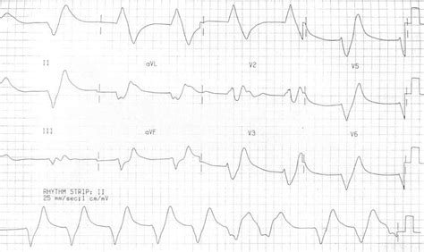 Killer Ecg Patterns Part 1 Artofit