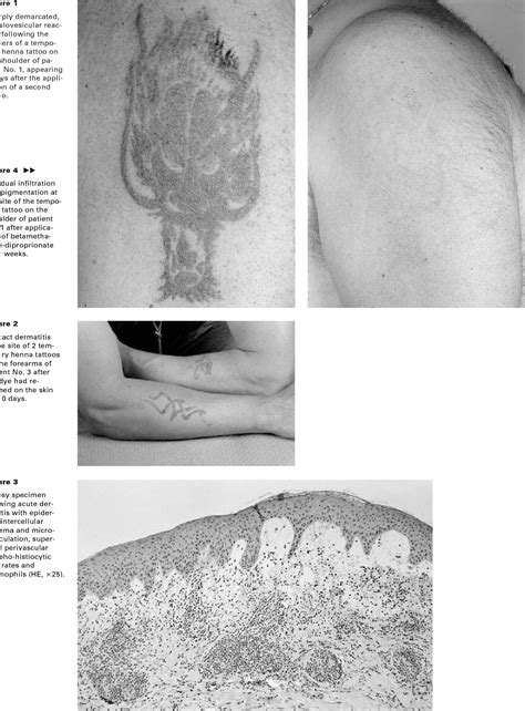 Spongiotic Dermatitis Semantic Scholar