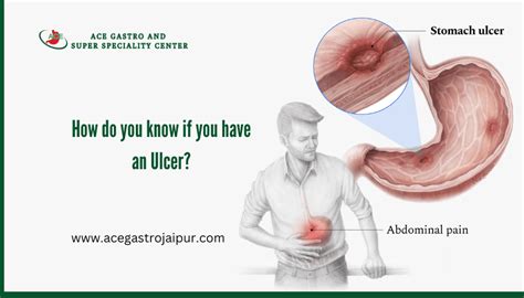 How Do You Know If You Have An Ulcer • Ace Gastro And Super Speciality