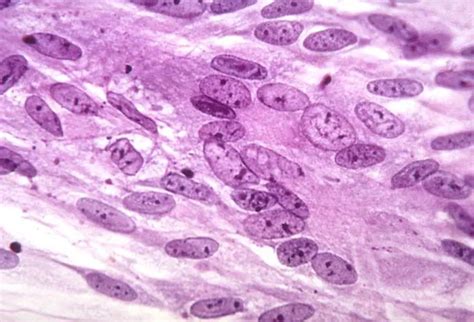 Can You Have A Mild Case Of Shingles Causes Symptoms Vaccines