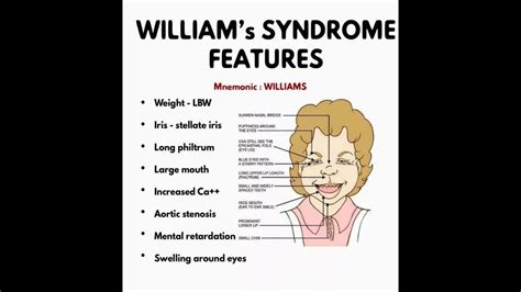 Williams Syndrome Symptoms Williams Syndrome Mums Struggle With
