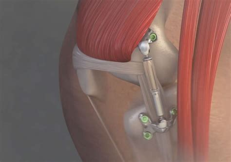 Moximed Secures Fda Nod For Misha System To Treat Knee Oa