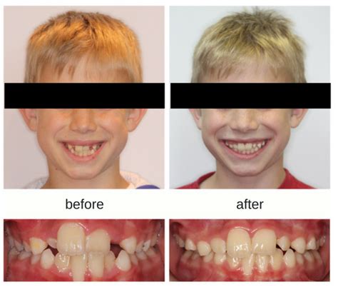 Underbite Overbite Crossbite What Do They Mean