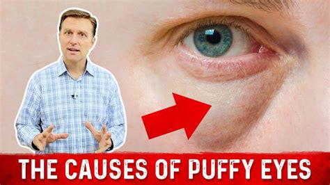 What Really Causes Puffy Eyes And Eye Bags Puffy Eyes Dr Berg Dr