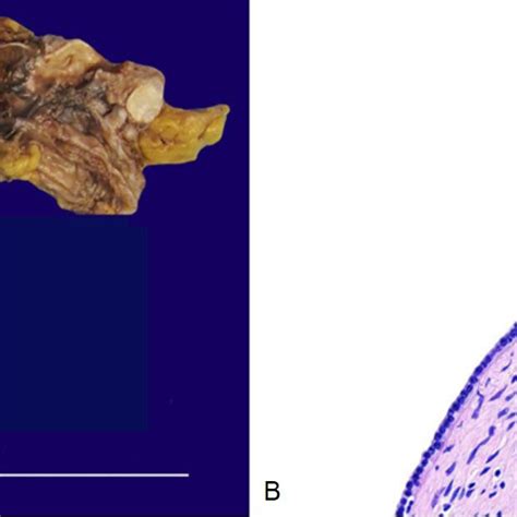 A Gross View Of The Left Seminal Vesicle Arrow And Cyst Asterisk Download Scientific