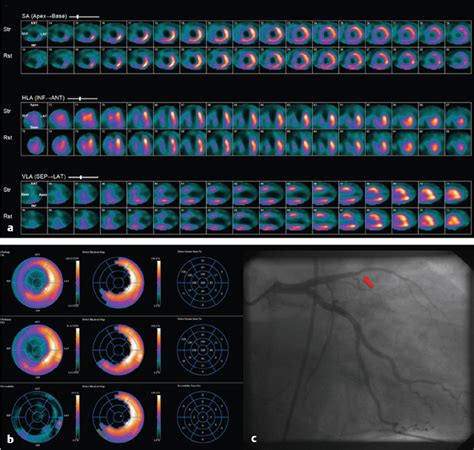 5 Spect And Spectct For The Cardiovascular System Radiology Key