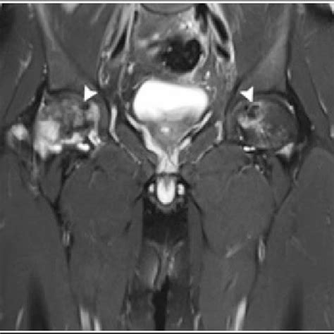 Coronal Inversion Recovery Mr Image Shows Mesencephalic Lesion With