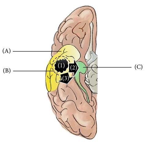 Options In Lesional Neocortical Temporal Lobe Epilepsy Ntle Surgery