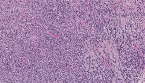 Ewing Sarcoma Histology Undifferentiated Pleomorphic Sarcoma