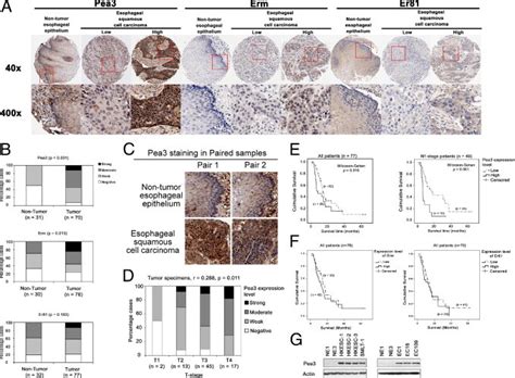 The Role Of Pea3 Group Transcription Factors In Esophageal Squamous Cell Carcinoma Pmc