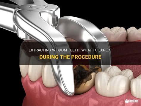 Extracting Wisdom Teeth What To Expect During The Procedure Medshun