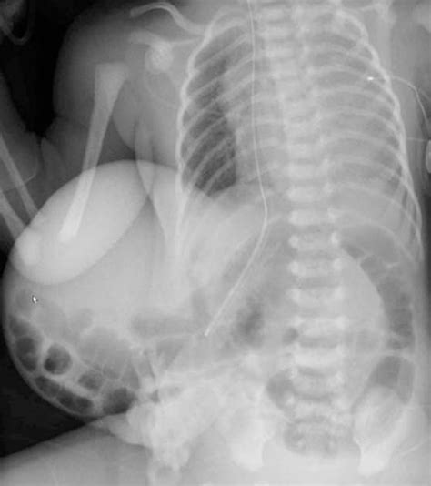Exomphalos Pacs