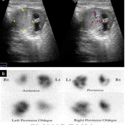 A Us Image Shows A Right Renal Mass On Color Doppler The Mass Download Scientific Diagram