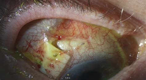 Conjunctival Dehiscence Repair