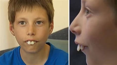 Crowding Diastema Spacing Crossbite Underbite Open Bite