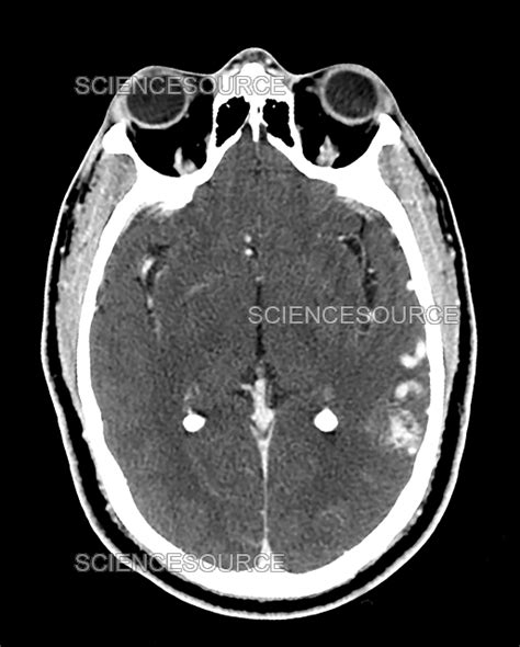Temporal Parietal Avm Stock Image Science Source Images