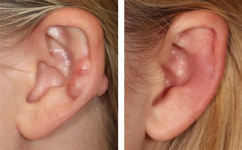 Keloid Ear Keloid Scars Treatment Glasgow Keloid Scars Removal