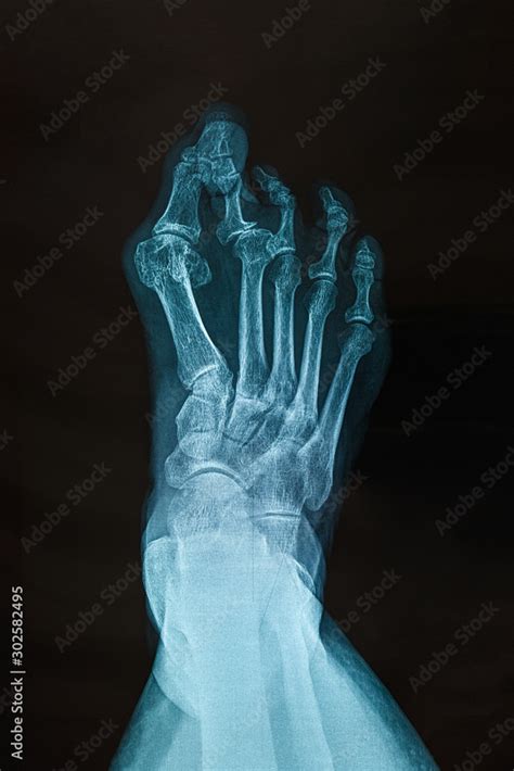 X Ray Of The Right Foot Transverse Plane Deviation Crossover Second Toe Deformity Transverse