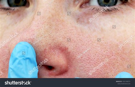 18 Imágenes De Cuperosis Imágenes Fotos Y Vectores De Stock