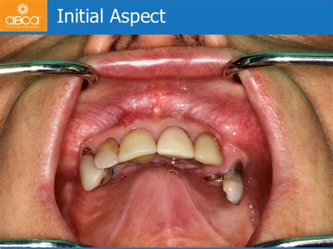 Maxillary Rehabilitation With Immediate All On 4 Augma Biomaterials