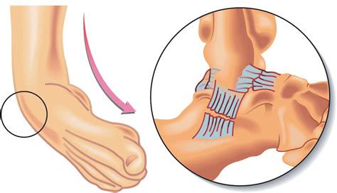 What Happens In An Ankle Sprain 3d Muscle Lab