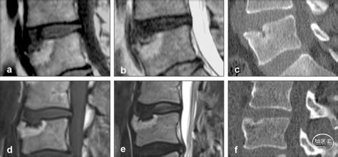 非特异性下腰痛modic变化的机制研究 脑医汇