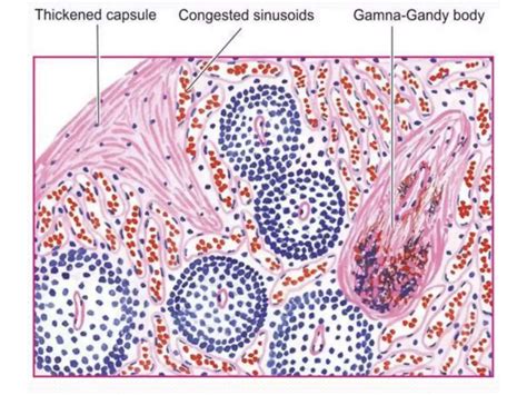 Hyperaemia Congrstion Haemoorhage Cvc Spleen Ppt