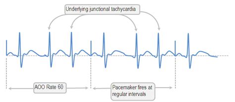 Single And Dual Chamber Pacing Modes Deranged Physiology