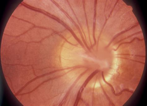 Optic Nerve Head Glial Tissue At Simon Henley Blog