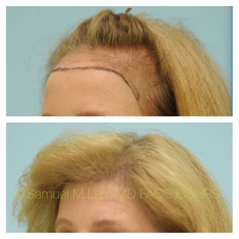 Discover 58 Female Hair Transplant Before And After Results And Hair