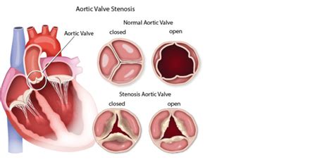 Leveraging Genetic Data To Identify Medical Therapies For Aortic