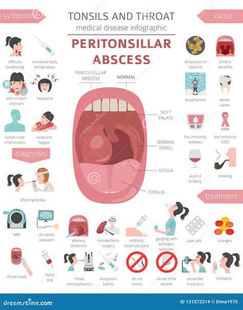 Tonsils And Throat Diseases Peritonsillar Abscess Symptoms Treatment