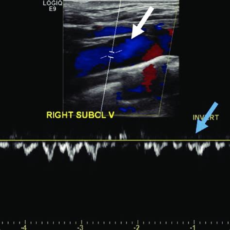 Pdf Upper Extremity Deep Venous Thrombosis Prophylaxis After Elective