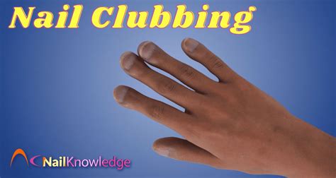 Nail Clubbing Nailknowledge
