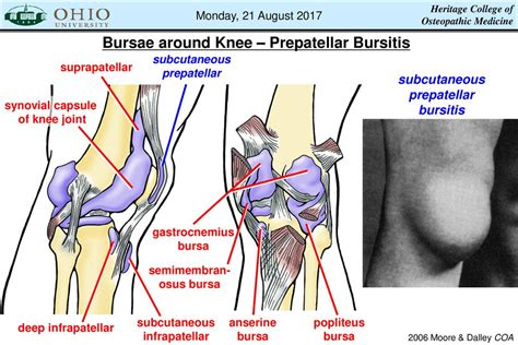 Femoral Head Dislocation Posterior Hip Dislocation Ppt Download