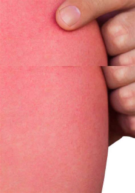 Urticarial Vasculitis Face