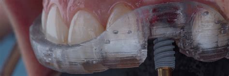 Stuart J Froum Dds Stuart J Froum Dds Offers Dental Implants To