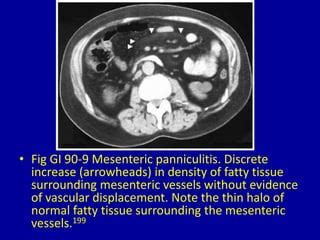 90 Fatty Lesions In The Abdomen And Pelvis Pptx