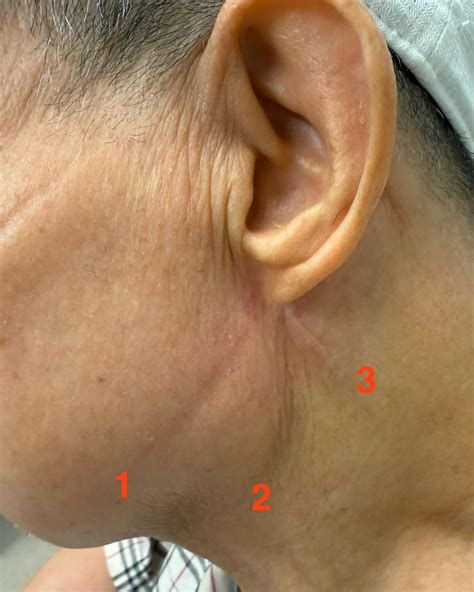 羅盛典 腮腺腫瘤 70歲男性，腮腺癌第三期 經歷手術及放射線治療 目前追蹤已近10年無恙 重點是 這樣的術後傷口 應該會讓更多的病患勇於接受腮腺腫瘤的手術治療吧～～☺️☺️ 讓你猜猜 1