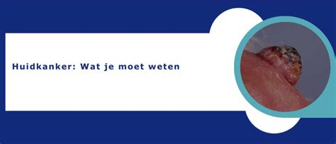 Voorstadia Van Huidkanker Wat Je Moet Weten Huidopleidingnl