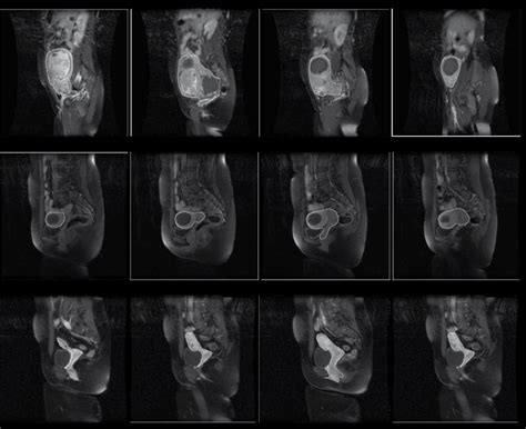 A 38 Year Old Woman With Uterine Fibroid Results Of Automatic