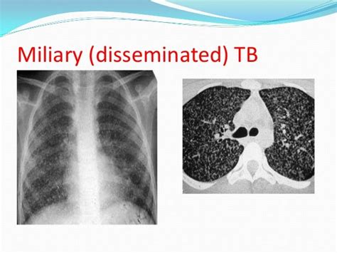 Pulmonary Tuberculosis 1