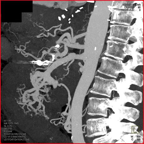 Vasculitis Mesentery Vascular Radiology Case Studies Ctisus Ct Scanning