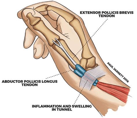De Quervains Tenosynovitis North Texas Orthopedic And Spine Center