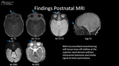 30 Week Fetus With Nasal Mass American Society Of Pediatric Neuroradiology