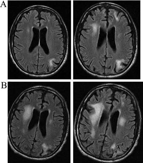 Progressive Multifocal Leukoencephalopathy Medizzy