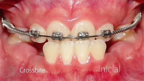 Braces Before And After No 6 My Son Has A Crossbite Youtube